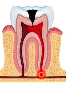 5 Stages of Tooth Decay - Dentist Near Joliet IL | 815-725-5991